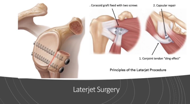 Shoulder Stabilization (Laterjet Procedure) – Dr. Omar Dessouki